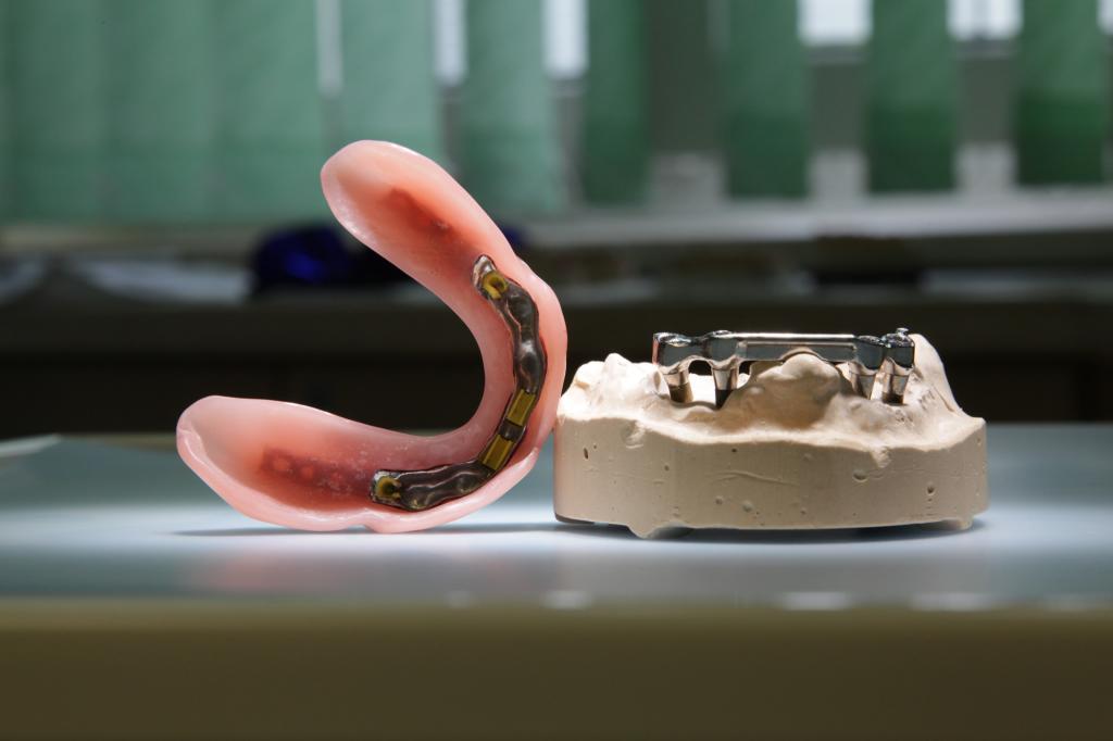 Implantatgetragene stegreitende herausnehmbare Deckprothese in München ...